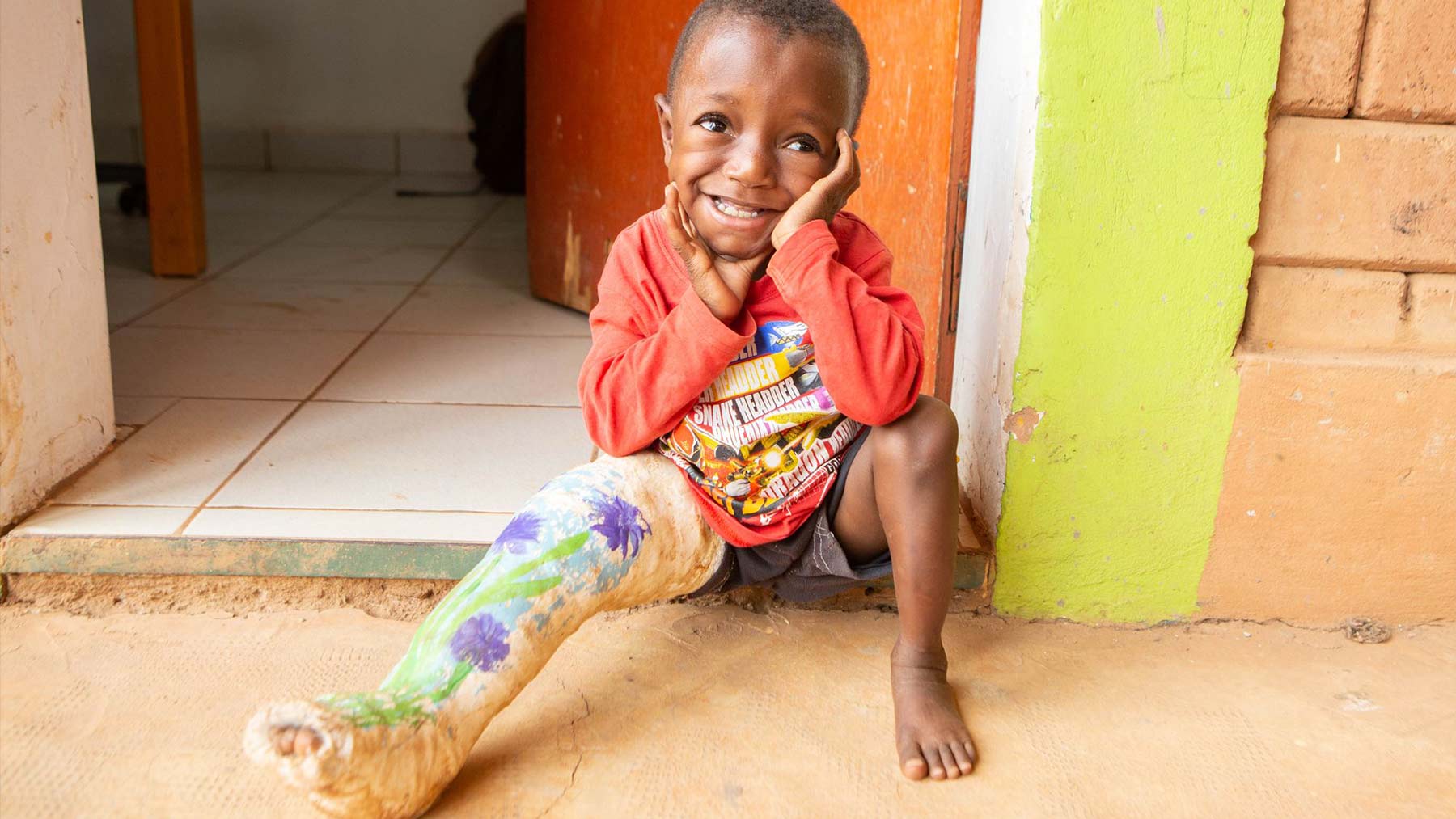 Osteogenesis Imperfecta Brittle Bone Disease CURE International Osteogenesis Imperfecta Brittle Bone Disease CURE International