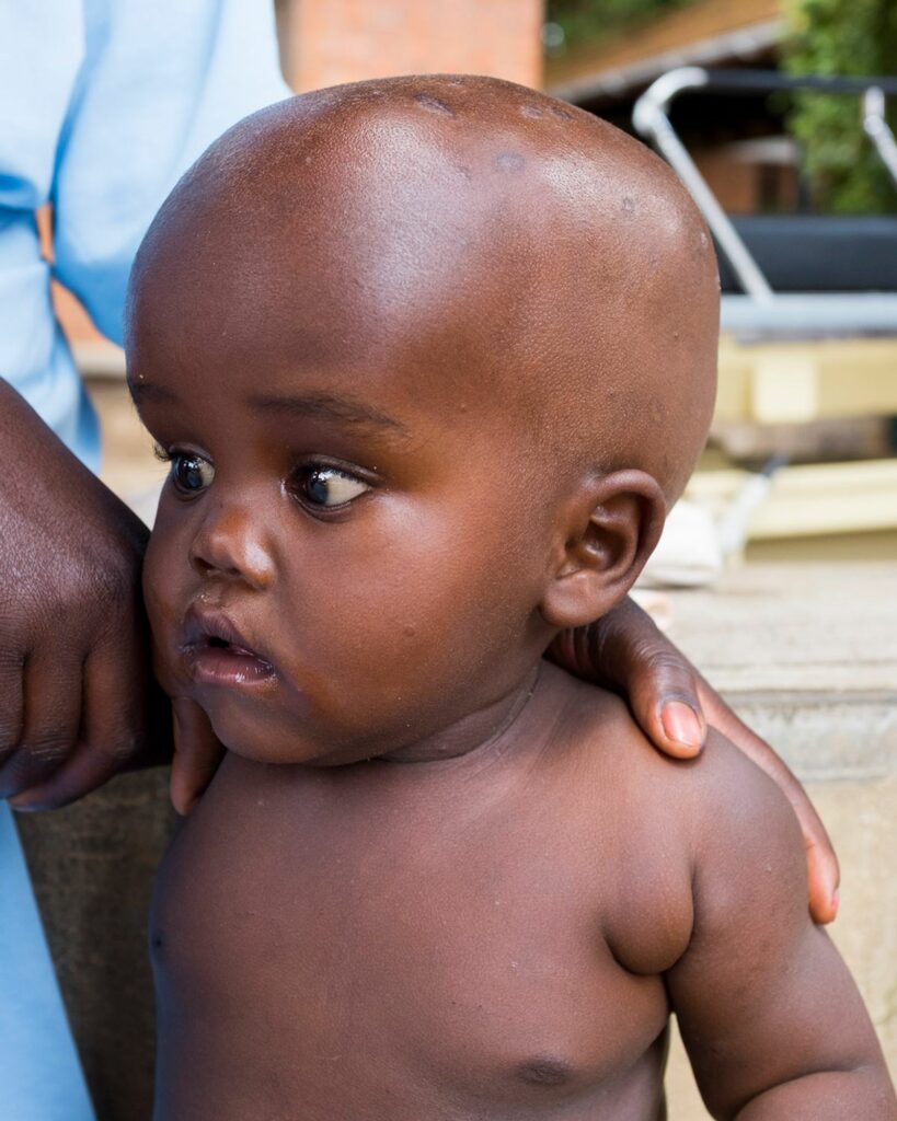 Hydrocephalus - CURE