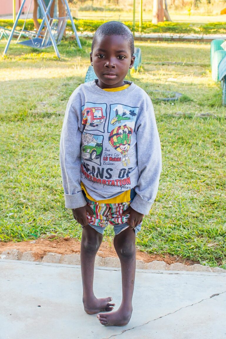 Clubfoot - CURE