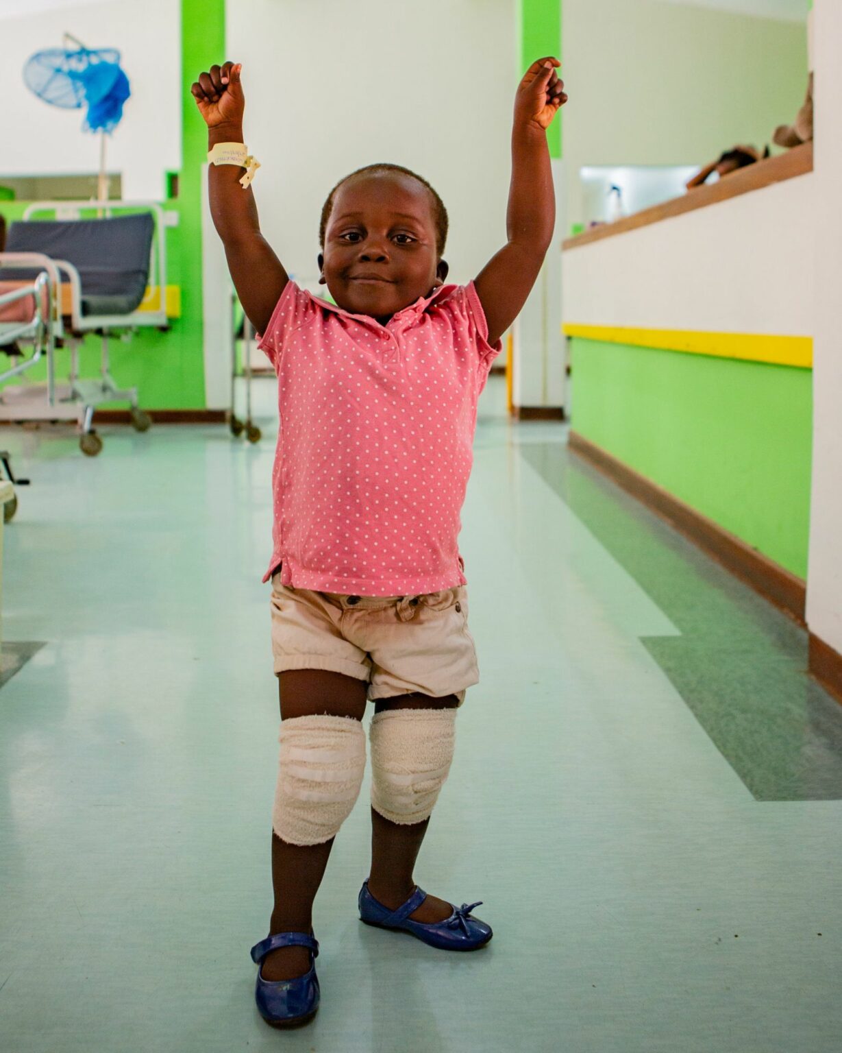 Genu Valgum (Knock Knees) - CURE