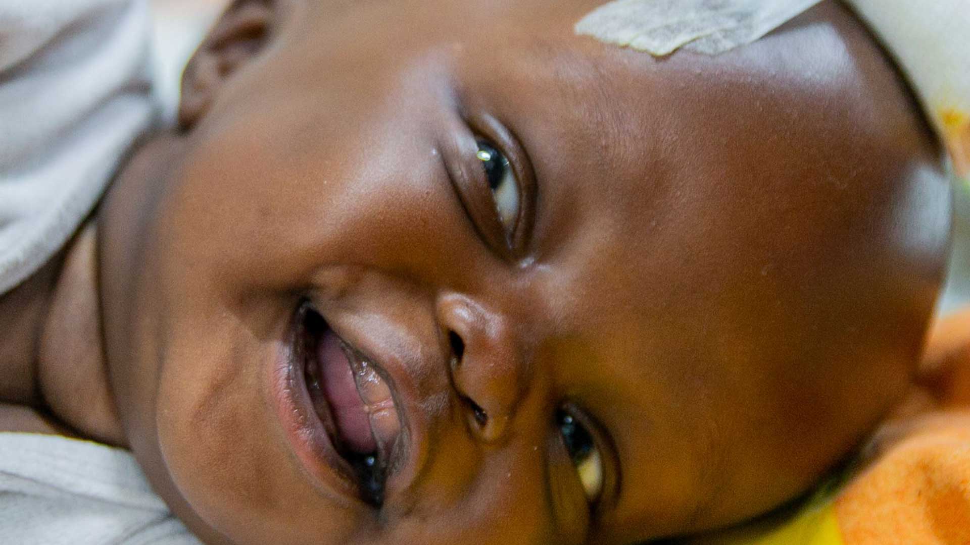 Management of Dandy-Walker complex–associated infant hydrocephalus by ...