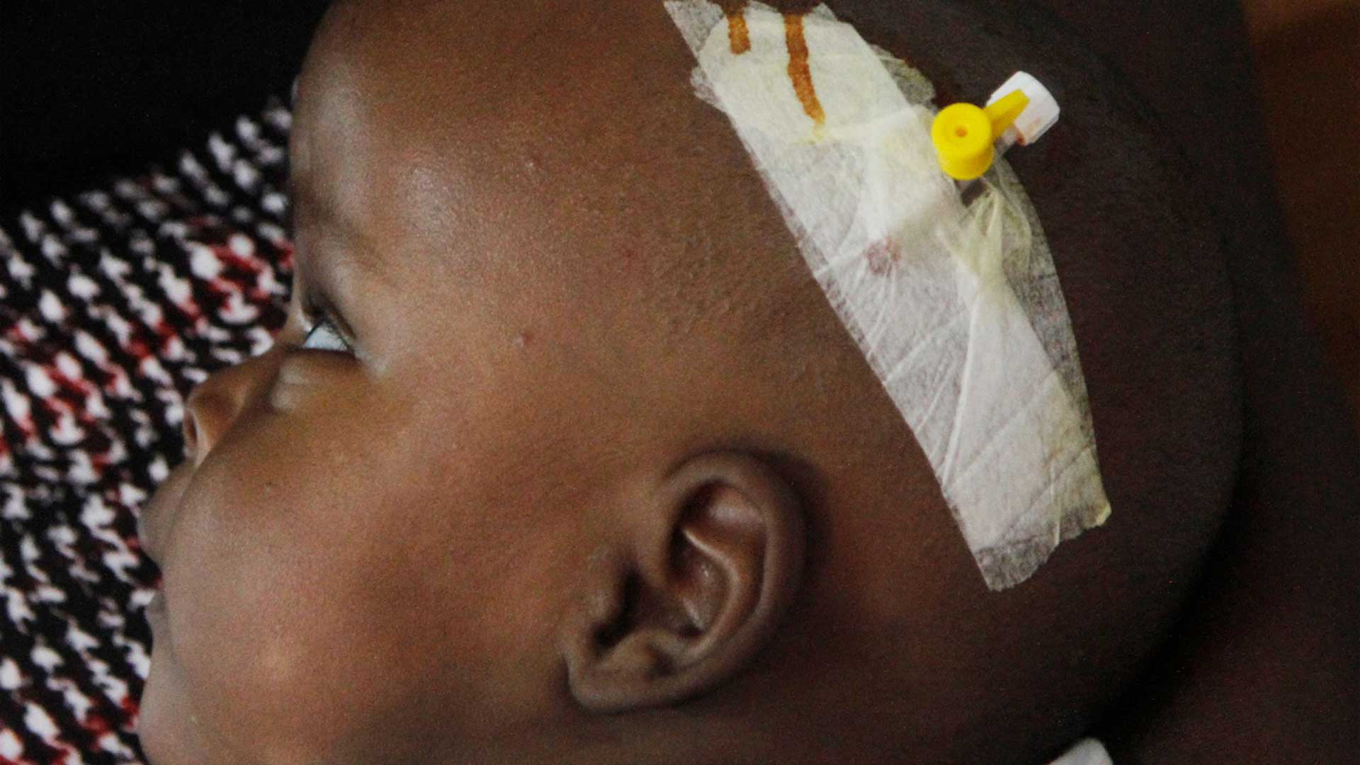 Comparison of 1-year outcomes for the Chhabra and Codman-Hakim Micro ...