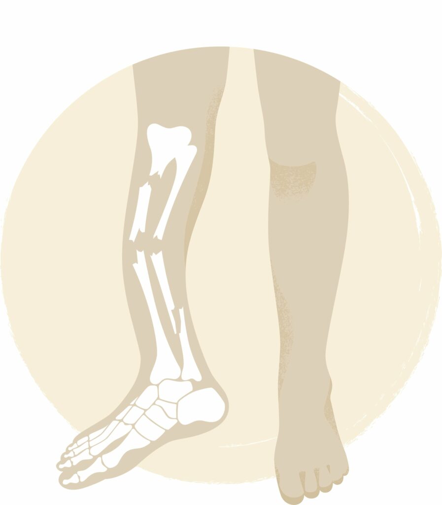 Osteogenesis Imperfecta (Brittle Bone Disease) - CURE