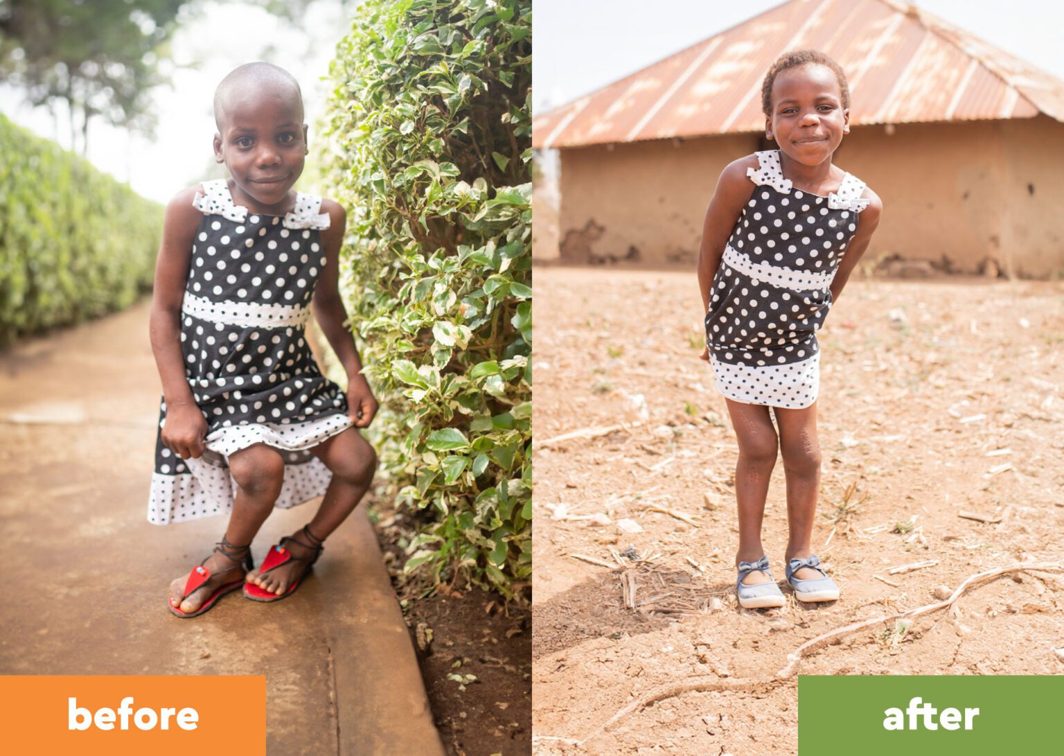 How CURE Treats Windswept Condition to Change Lives - CURE